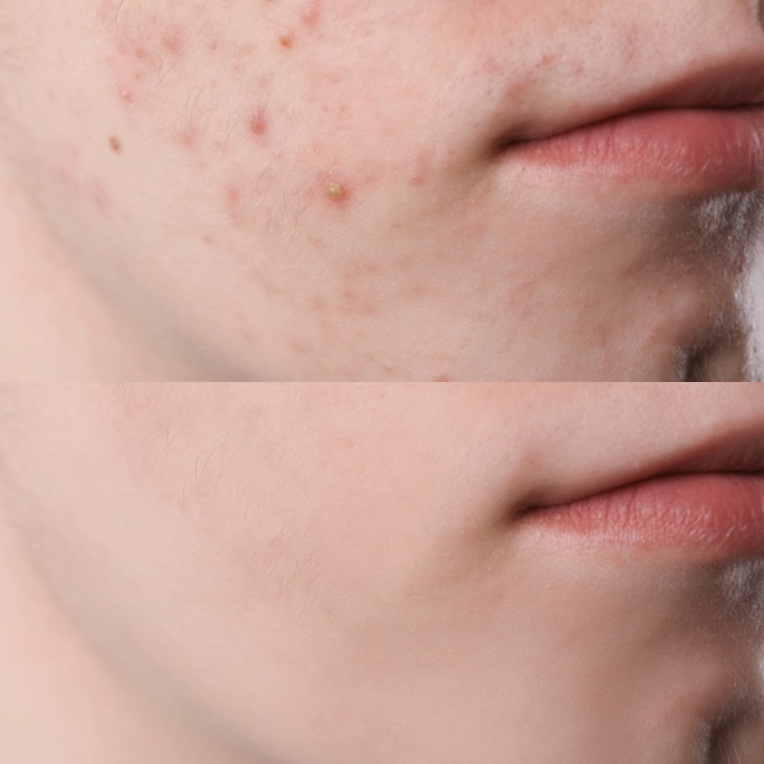 Acne Solutions at Recharge Clinic: Real Tools, Real Results